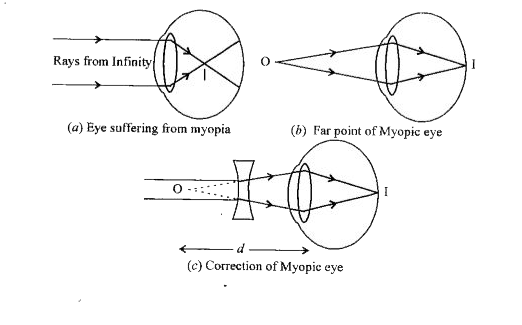 What is Myopia ? What are its causes ? Explain with the help of