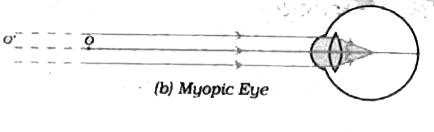 [Kannada] A person with a myopic eye cannot see objects beyond 1.2 m d