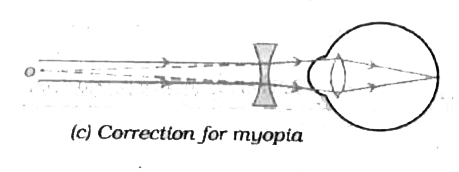 [Kannada] A person with a myopic eye cannot see objects beyond 1.2 m d