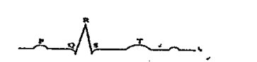 In the following diagrammatic representation of a standard ECG the 'T'